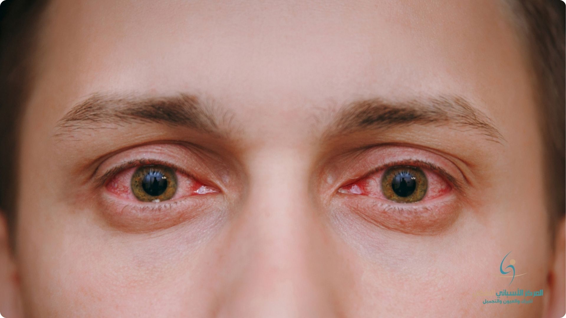 What is the cause of sudden redness in the whites of the eyes? When is ...